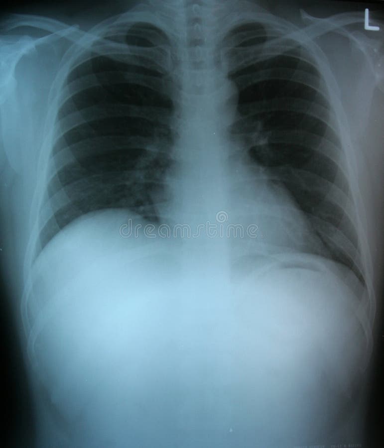Normal Chest X Ray Child