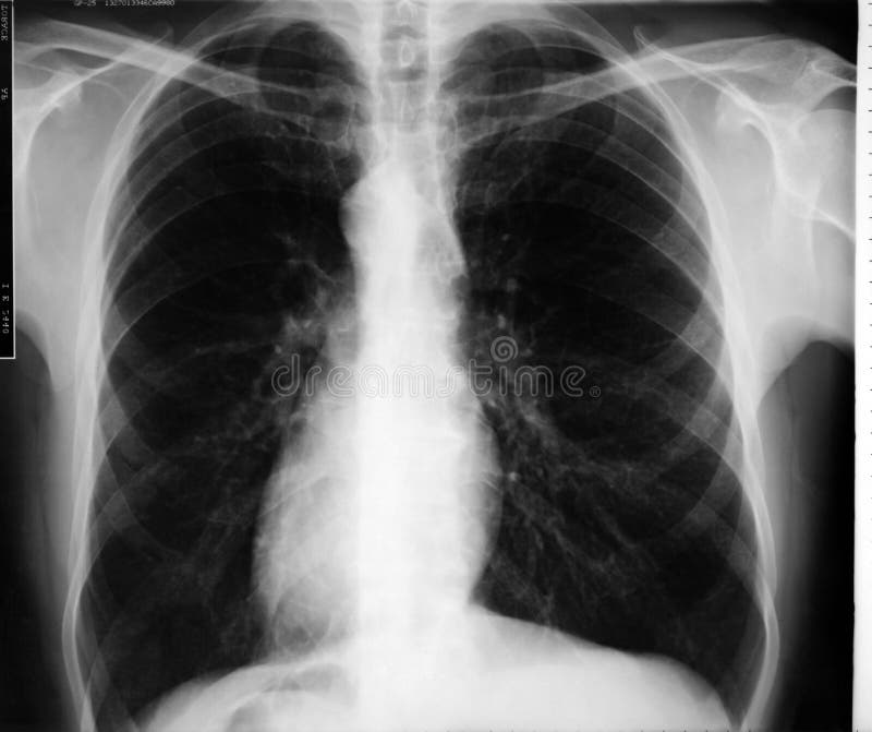 Chest X-ray stock photo. Image of film, hospital, chest - 9893328