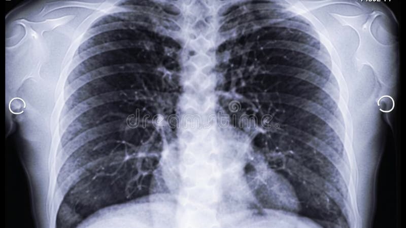 Detailed Examination of Chest X-ray Revealing Lung Conditions and ...