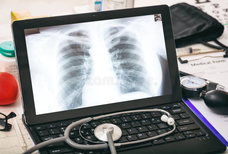 Chest X Ray on a Doctor`s Computer Screen Stock Photo - Image of ...