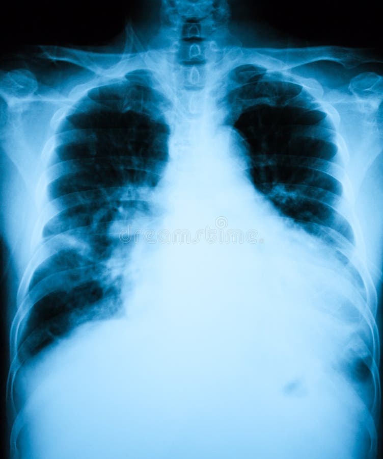 Chest X-ray Image, AP Upright View. Stock Image - Image of spine, chest ...