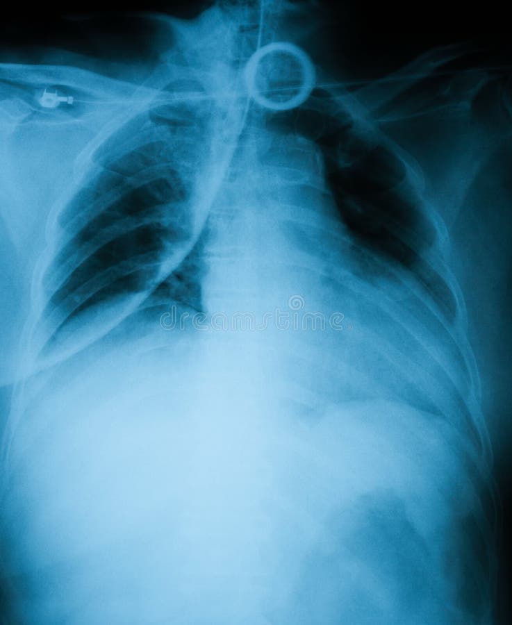 Chest X-ray Image, AP View. Stock Image - Image of father, elbow: 55477413