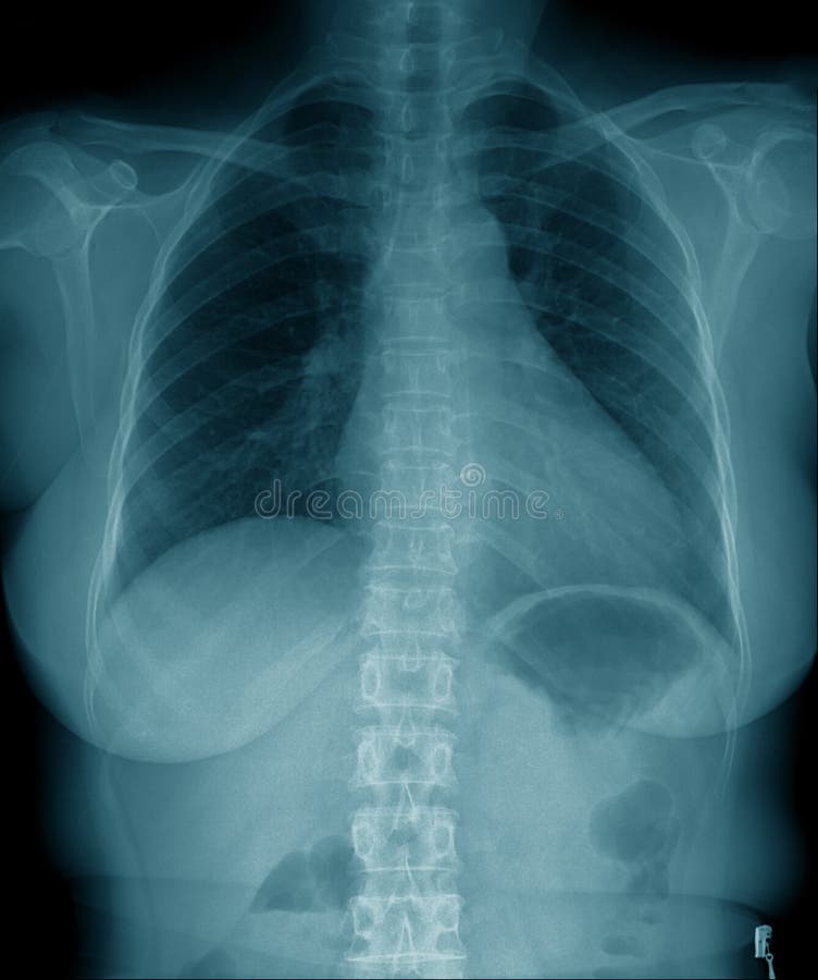 Chest X-ray Image in Blue Tone Stock Photo - Image of illness, hospital ...