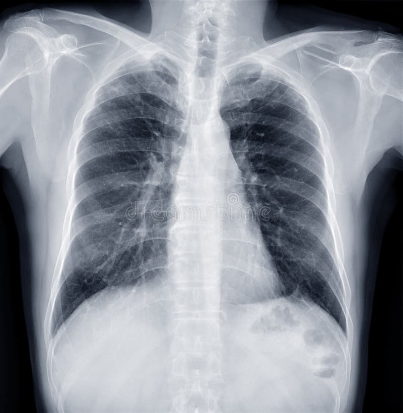 Chest X-ray or X-Ray Image of Human Chest . Stock Image - Image of ...