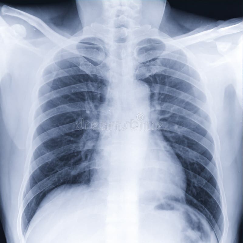 Chest X-ray or X-Ray Image of Human Chest with Pacemaker Placement ...