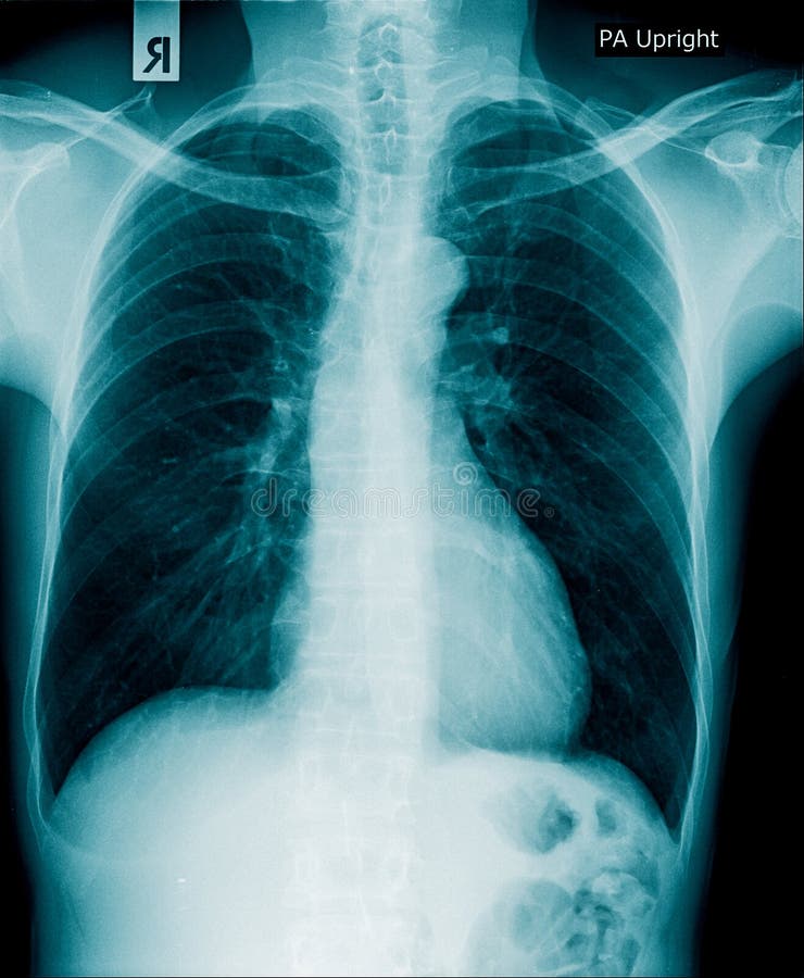 Chest X-ray Image with Lung View in Blue Tone Stock Image - Image of ...