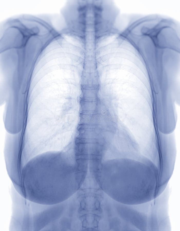 Chest X-ray Image Negative Filter Stock Image - Image of emphysema ...