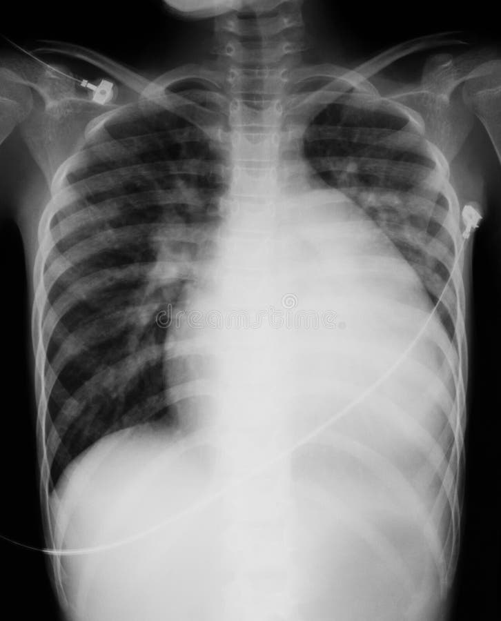 Chest X-ray image. stock image. Image of clinical, hand - 55030377