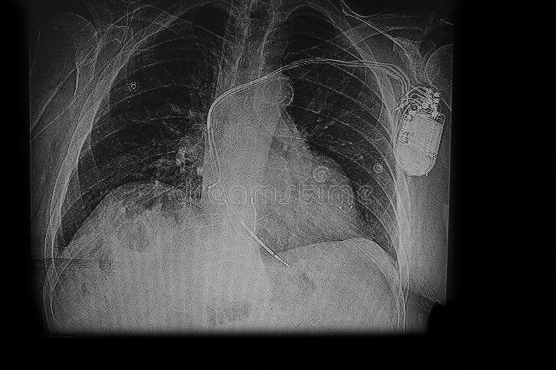 Chest X Ray Image Showing Heart Pacemaker. Stock Image - Image of ...