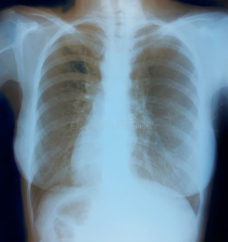 Chest X-ray Image of Healthy Woman Stock Image - Image of breast, pain ...