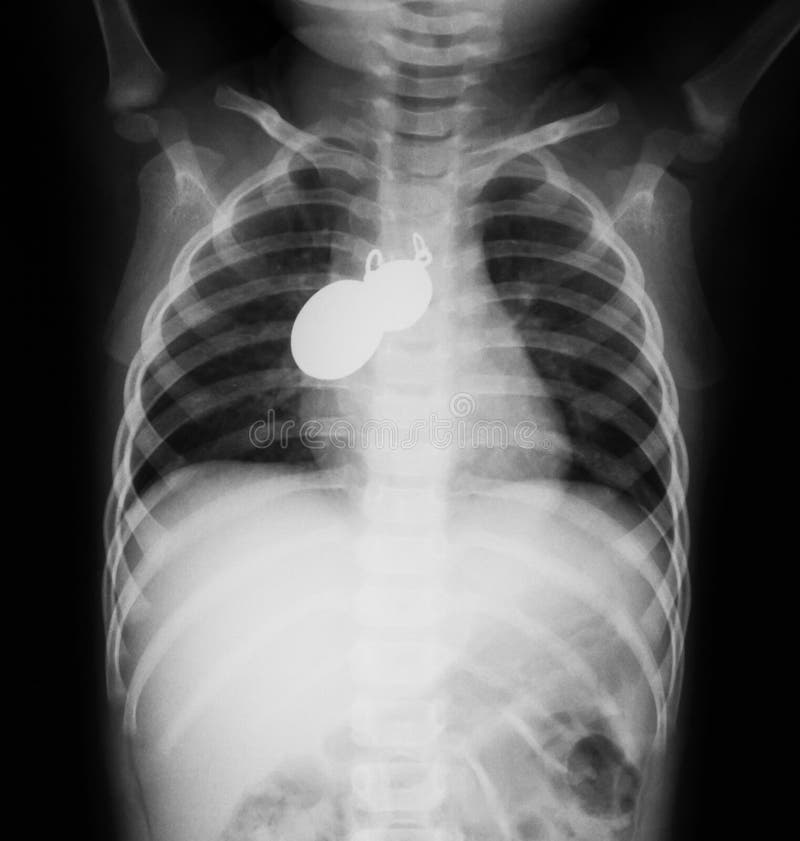 Chest X-ray image. stock image. Image of intensive, bronchus - 55030383