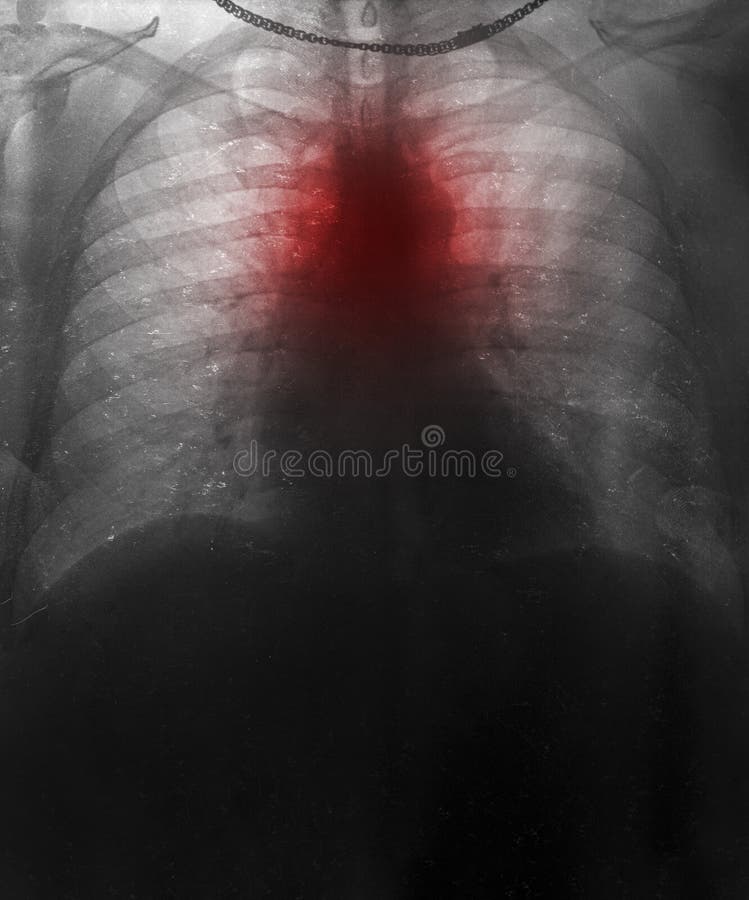 Chest X-ray of a Man Having a Heart Attack and Highlighted with a Red ...