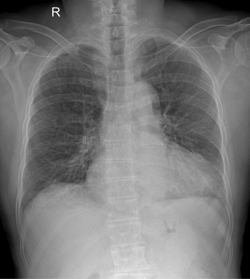 Chest X-Ray: a Radiographic Technique for Evaluating Thoracic ...