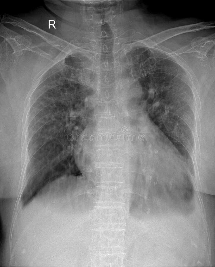 Chest X-Ray: a Radiographic Technique for Evaluating Thoracic ...