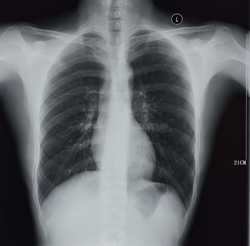 Chest X-rays stock image. Image of diagnose, lung, human - 64340649