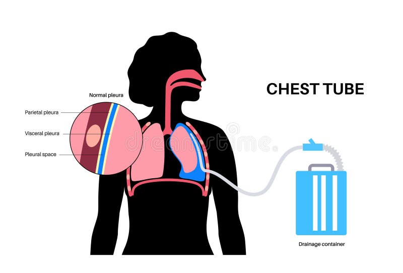 Chest tube catheter stock illustration. Illustration of system - 277272961