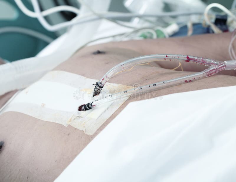 Chest Wound Drainage of the Patient Stock Photo - Image of nursing ...