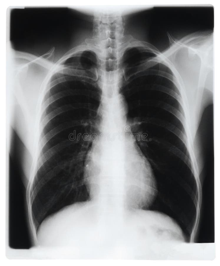 Chest X-ray Stock Photography - Image: 8701432