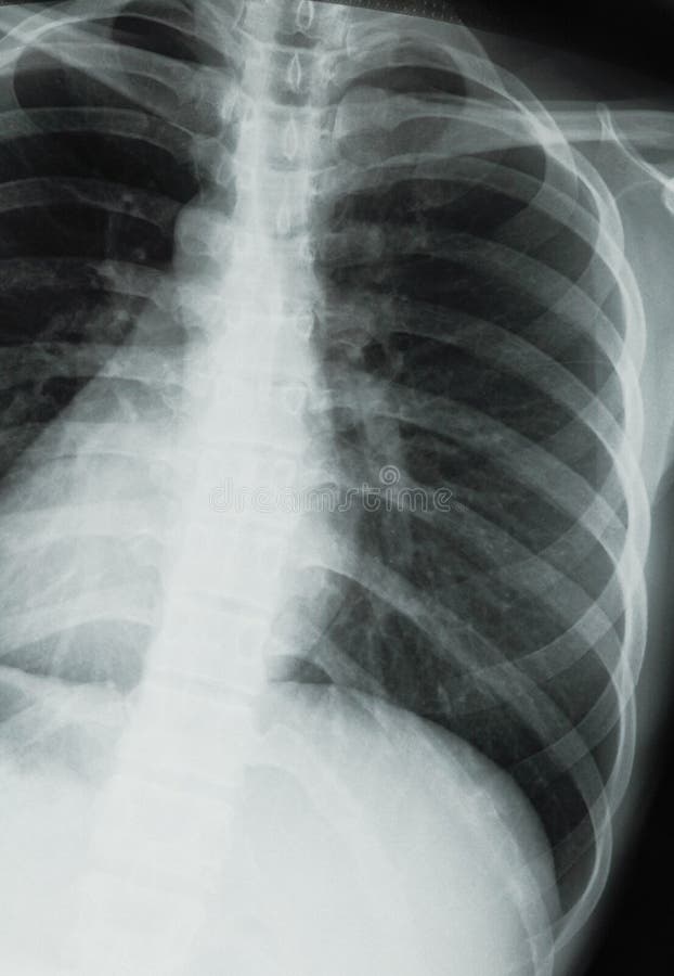Chest xray scan stock image. Image of chest, radiology - 30664561