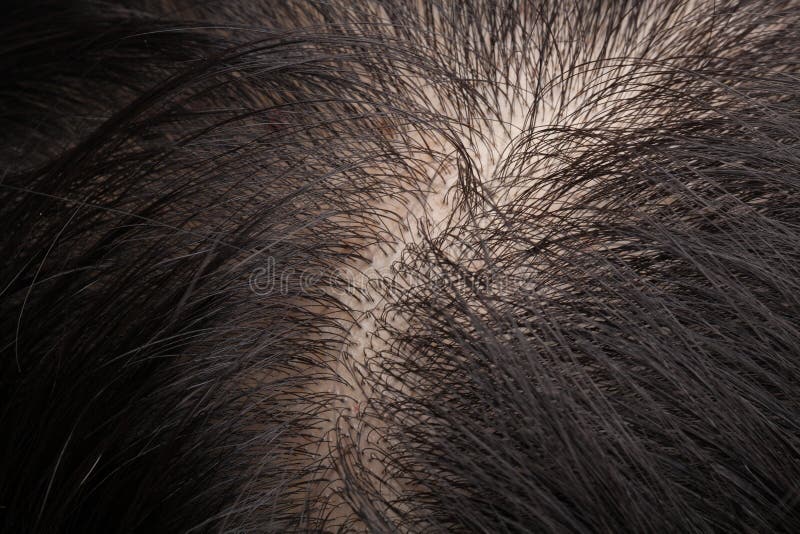 Cuir Chevelu De Cheveux Avec Des Pellicules Et écallieux Du Psoriasis ...