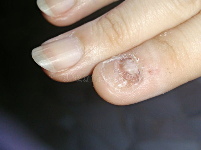 Chewed fingernail stock image. Image of chewed, compare - 49771599