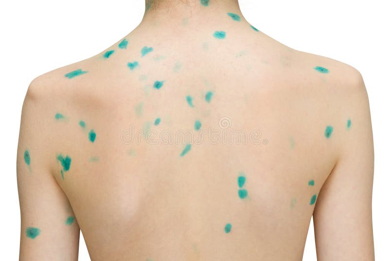Chicken pox stock photo. Image of antiseptic, contagious - 23327584