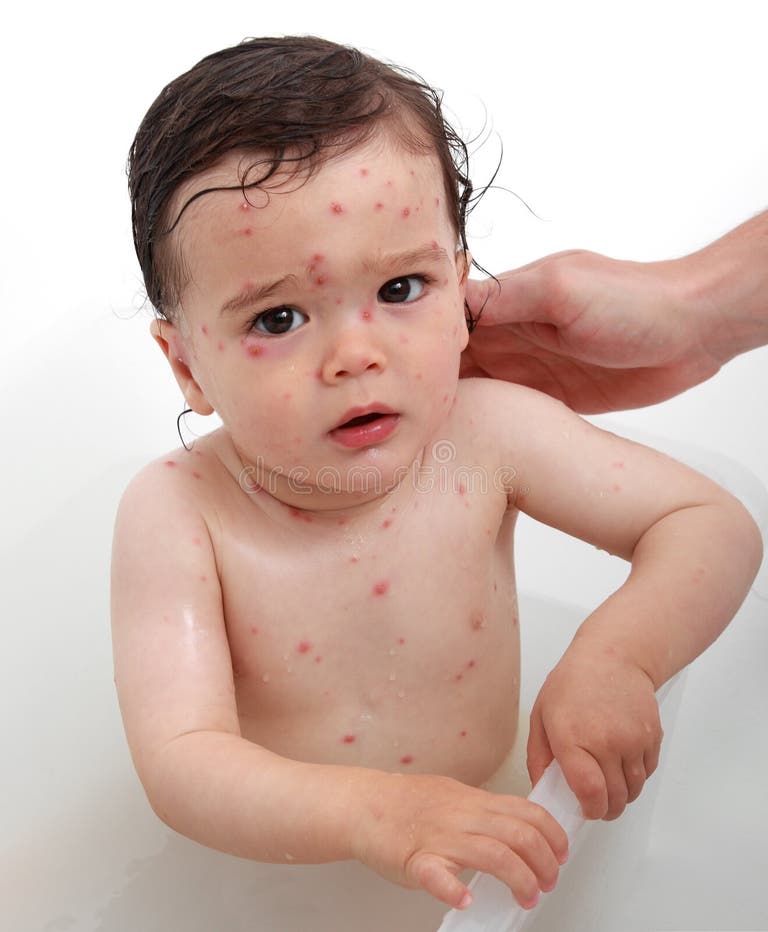 2,339 Pox Rash Stock Photos - Free & Royalty-Free Stock Photos from ...