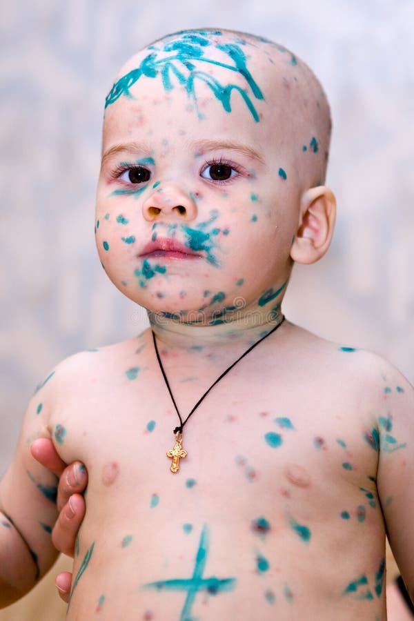 Chicken Pox Picture. Image: 5863343