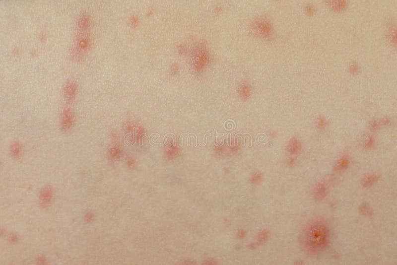 Chicken pox stock photo. Image of illness, symptoms, healthcare - 30937114