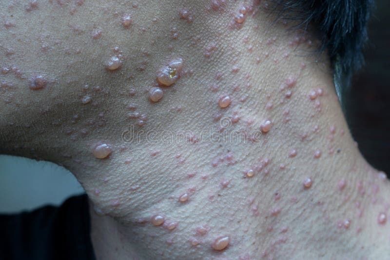 Chicken pox stock image. Image of person, closeup, infection - 270958857