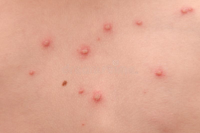 Chickenpox stock photo. Image of sick, pimples, itch - 12338740