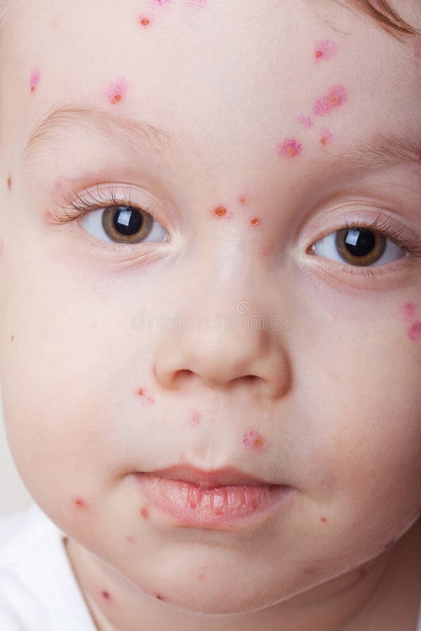 Chickenpox stock photo. Image of influenza, eyes, medic - 22851566