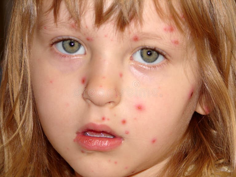 Chickenpox stock image. Image of work, physician, illness - 2588913