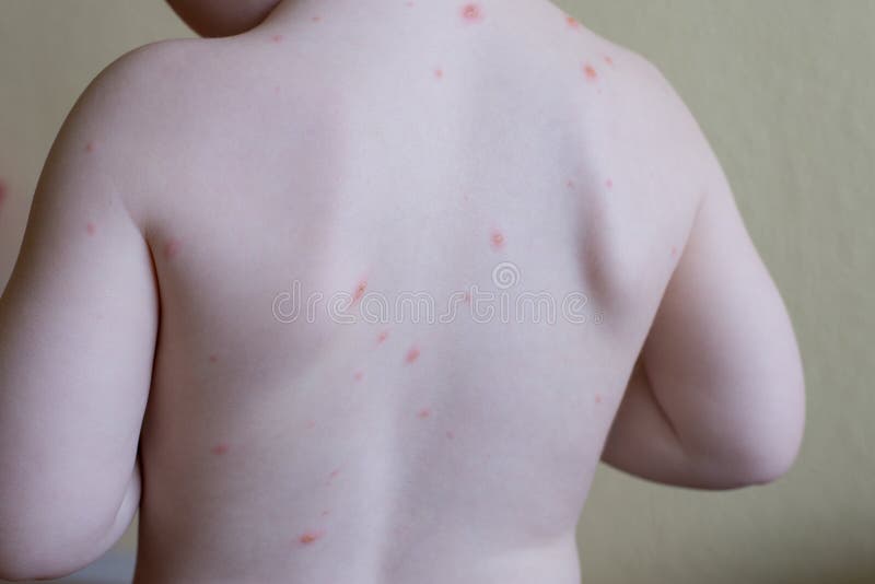 Chickenpox Pattern Stock Photos - Free & Royalty-Free Stock Photos from ...