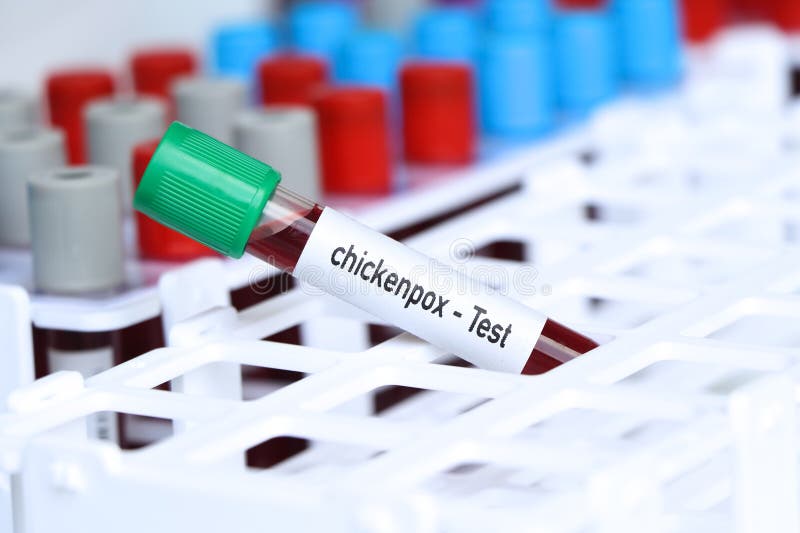 Chickenpox Test, Blood Sample To Analyze in the Laboratory Stock Photo ...