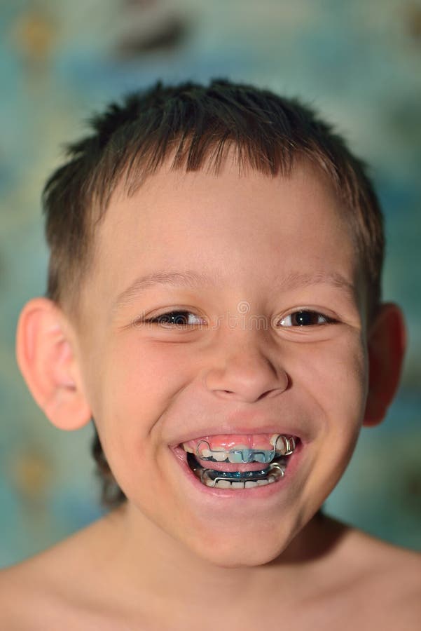 A child with braces smiles stock image. Image of young - 140611153