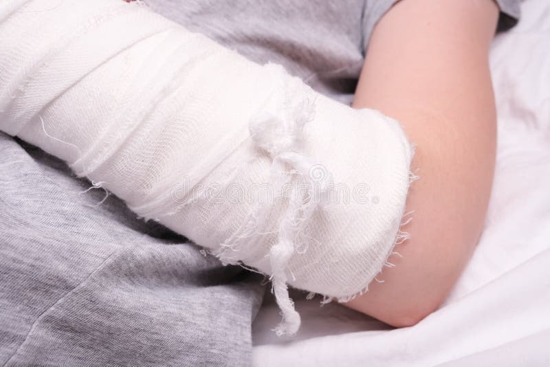A Child Broken Arm in Plaster Case, Hand Injury because of Accident ... A Child Broken Arm in Plaster Case, Hand Injury because of Accident ...