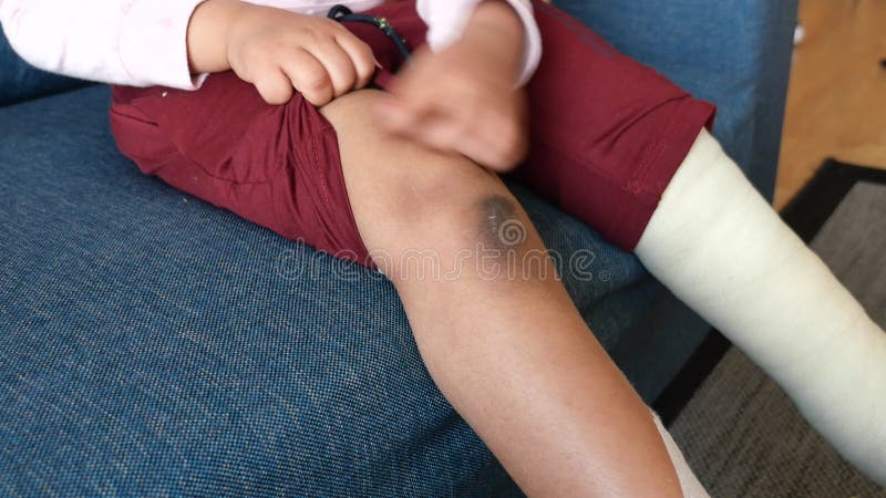 Child with a Bruised Knee and Leg Cast Stock Footage - Video of bruise ...