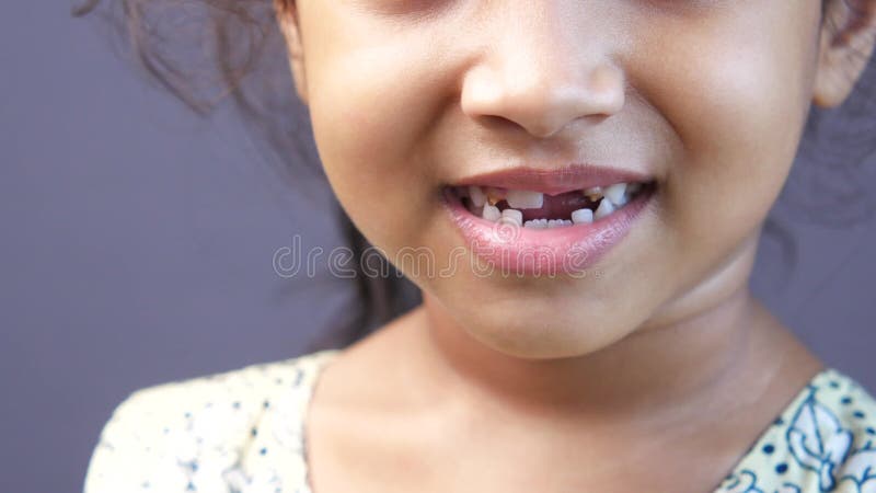 Child Girl Smiling with Deformed Teeth Stock Footage - Video of girl ...