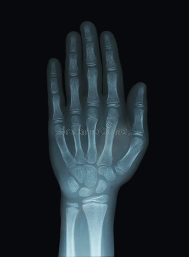 1,042 X Ray Human Hand Finger Stock Photos - Free & Royalty-Free Stock ...
