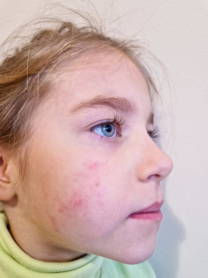 Allergic Rash on Cheeks in Child Stock Photo - Image of freshness ...