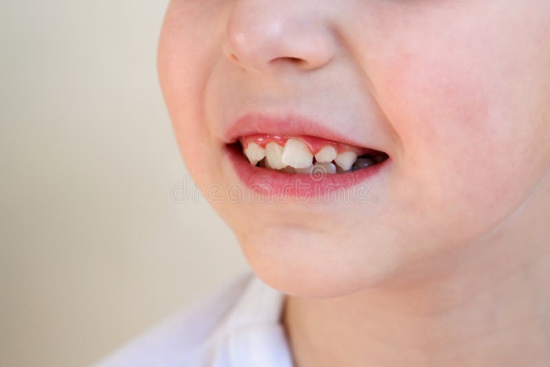 Bad Molars Stock Photos - Free & Royalty-Free Stock Photos from Dreamstime