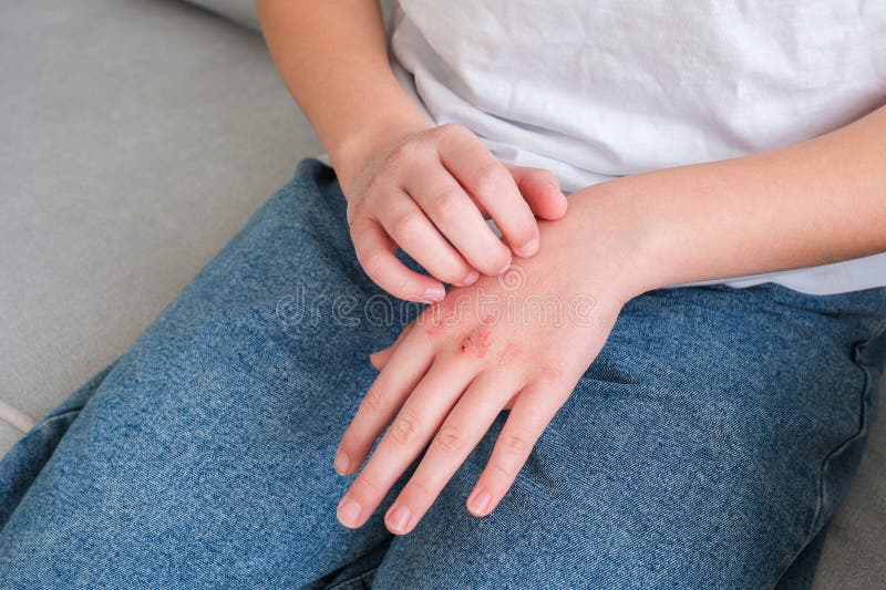 The Child Has Dry Skin on His Hands Stock Image - Image of crack ...