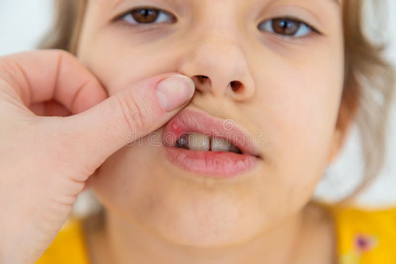 The Child Has Stomatitis on the Lip. Selective Focus Stock Image ...