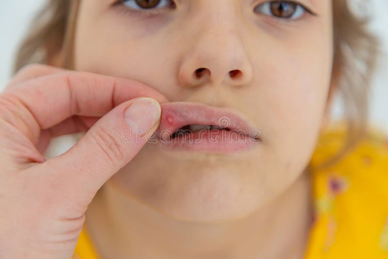 The Child Has Stomatitis on the Lip. Selective Focus Stock Image ...