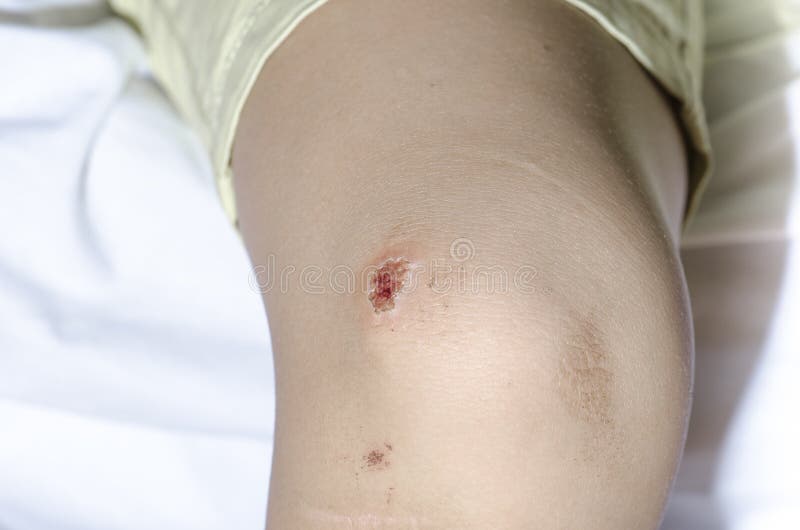 Child Hurt His Knee, an Abrasion on the Pavement Stock Photo - Image of ...