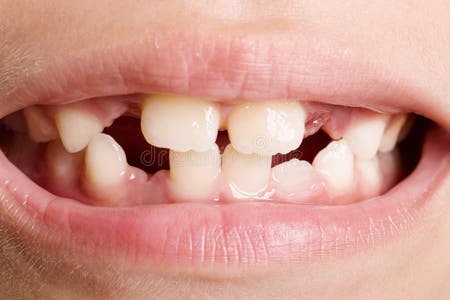 Child missing front teeth stock image. Image of incisor - 133831209