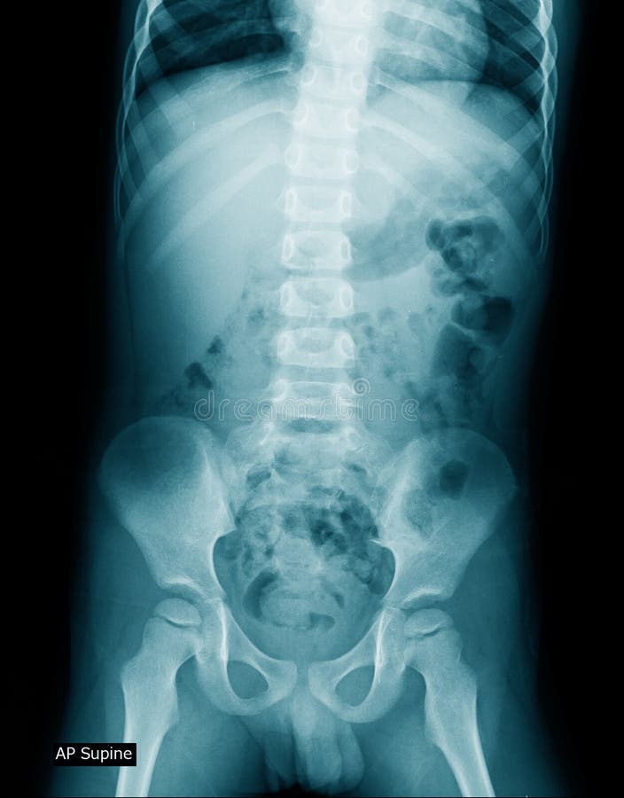 Child x-ray image of human stock photo. Image of hospital - 221727852