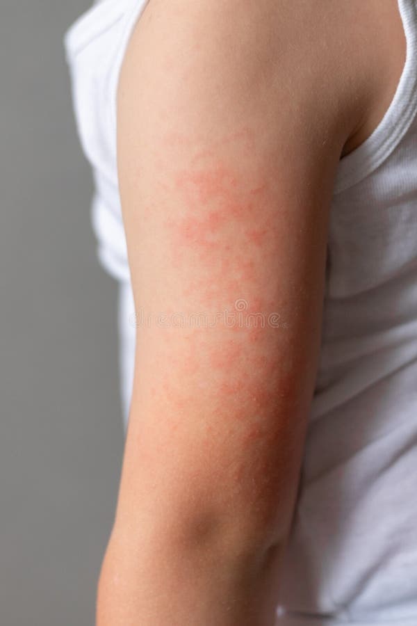 Child& X27;s Arm with Red Rash Stock Photo - Image of skin, pediatric ...
