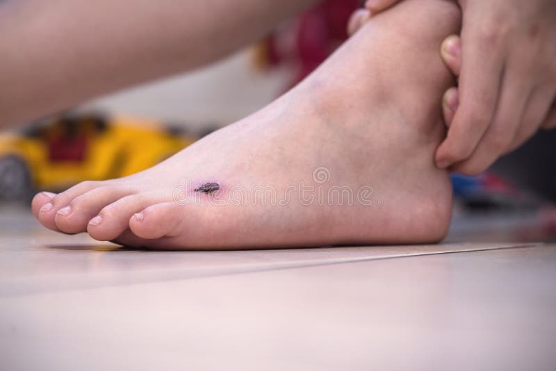 Child`s Foot, Boy with Wound, Injured Foot Stock Image - Image of ...